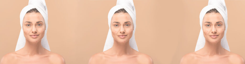 5 Easy Ways to Treat Your Postpartum Acne - MotherGeek - Geeky UK Blog